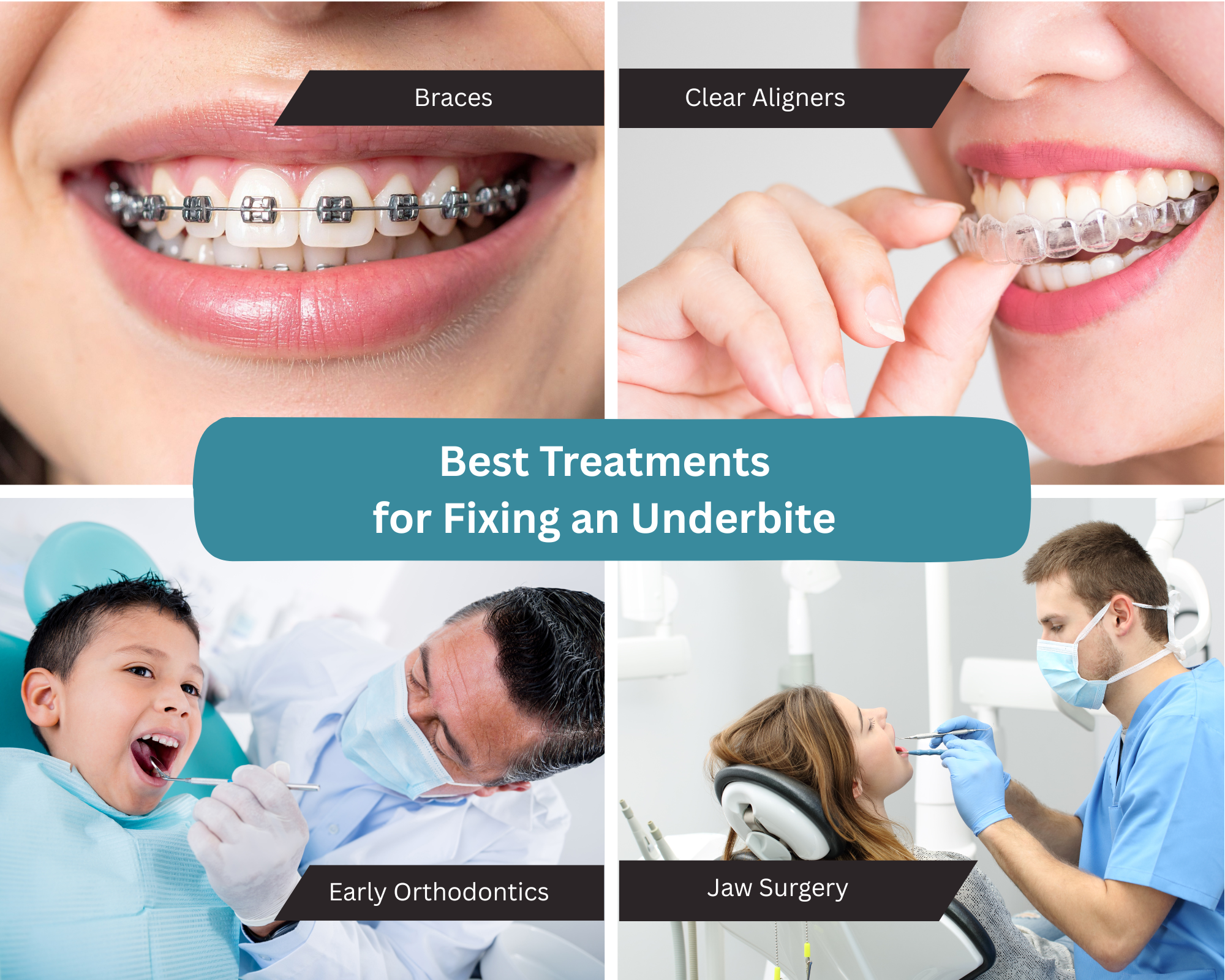 How to Fix an Underbite: Best Treatments and Results